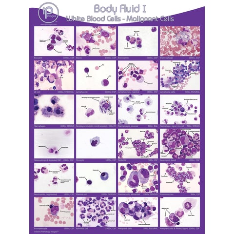 Body Fluid I: WBCs-Malignant Cells Poster | Marketlab